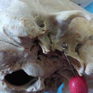 Lateral Right View Of The Infratemporal Region Of The Skull An Download Scientific Diagram