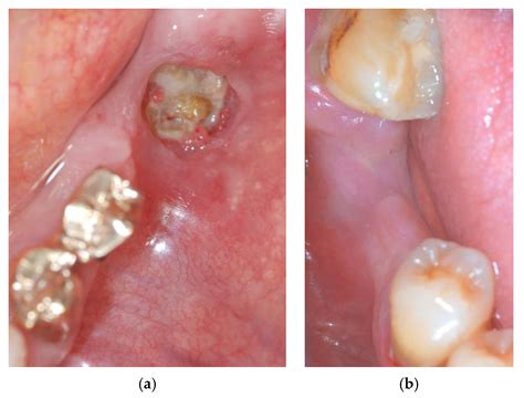 Tooth Extraction Bone Sequestra At Declan Thwaites Blog