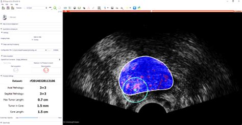 7 guidance interface implemented as part of a 3d slicer module cancer