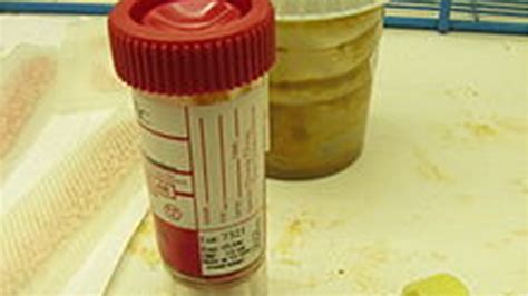 Pemeriksaan Makroskopis Feses Pemeriksaan Makroskopis Feses