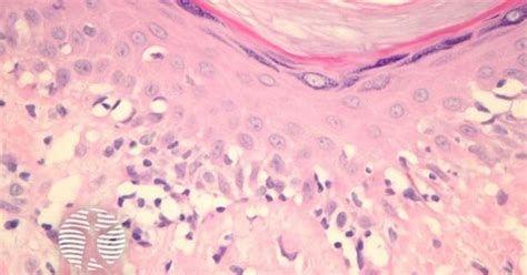 Melanoma Pathology Lentiginous Melanoma Image