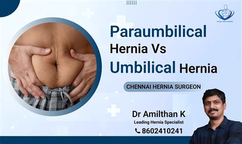 Paraumbilical Hernia Vs Umbilical Hernia Chennaiherniasurgeon