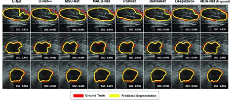 Breast Lesion Segmentation Result Of Three Randomly Selected Samples