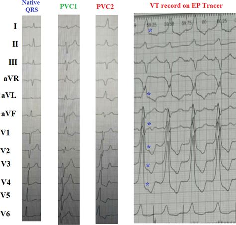 Two Different Pvc Morphologies Seen In The Superficial Ecg Recording Of