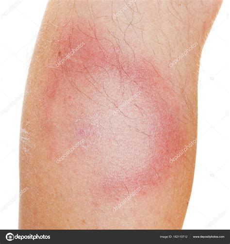 Erythema Migrans Images