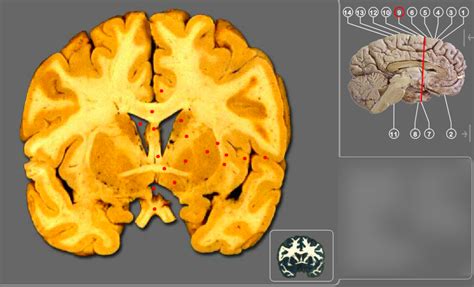 Corte Coronal De Cerebro 4 Diagram Quizlet