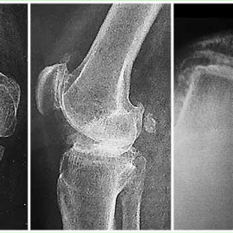Preoperative Right Knee Radiographs Kellgren And Lawrence Grade 4 Download Scientific Diagram
