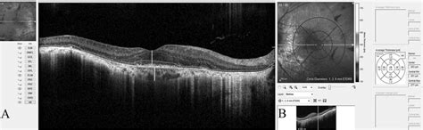 retinal layer segmentation on heidelberg spectralis sd oct machine a