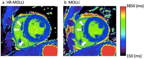 Examples Of High Resolution Modified Look Locker Inversion Recovery Download Scientific Diagram