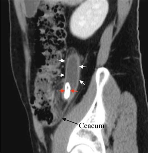 Practical Points In Diagnosis Of Acute Appendicitis By Ct Image And Or Pelvic Ultrasonic Scan A