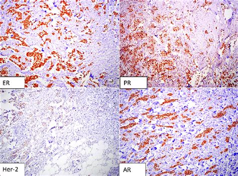 Diffuse Strong Nuclear Staining For Androgen Receptor Original