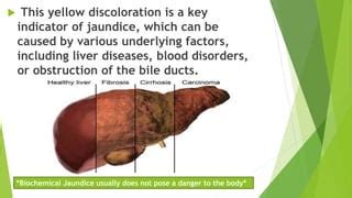 Jaundice Definition Diagnosis Causes Pptx