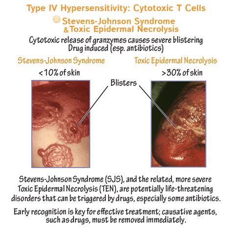 Clinical Pathology Glossary Stevens Johnson Syndrome And Toxic Epidermal