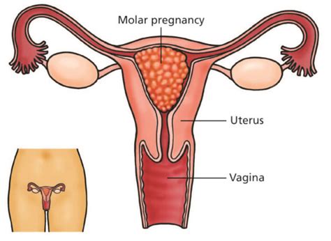 Hydatidiform Mole Molar Pregnancy Nurses Revision