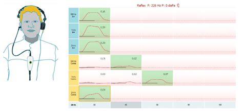 Titan Acoustic Reflex Testing Interacoustics