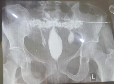 Fistulogram With A Fistulous Tract Between The Uterus And Abdominal