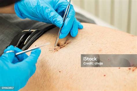 Patient After Laparoscopic Surgerygall Bladder Operation 照片檔及更多 人類腹部 照片 Istock