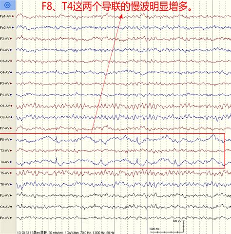 痫样放电 脑电图痫样放电 伤感说说吧