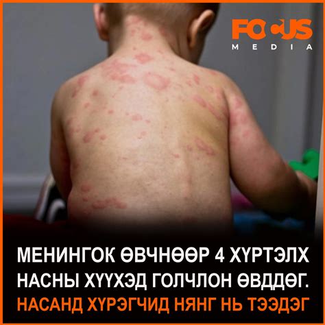 ФОКУСЛАВ Менингок өвчнөөр 4 хүртэлх Баримтыг фокуслана