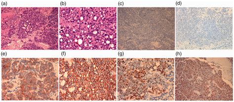 Epsteinbarr Virus Associated Poorly Differentiated Nasopharyngeal