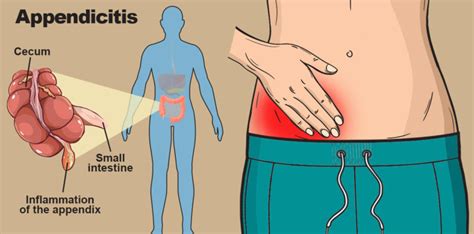 6 Things You Need To Know About Your Appendix By Dr Vaibhav Kapoor