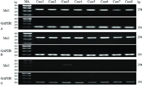 The Expression Of Msi1 Gene In Brain Metastases Primary Tumor And Download Scientific Diagram