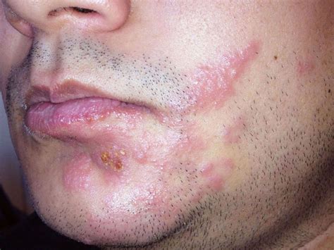 Dermatomes Face Shingles