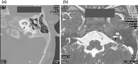 Hypoplastic Cochlear Aperture A Black Arrow With A Hypoplastic Download Scientific Diagram