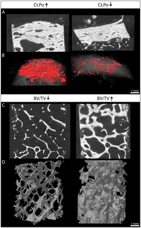 Cortical And Trabecular Bone Microstructure In Male Idiopathic