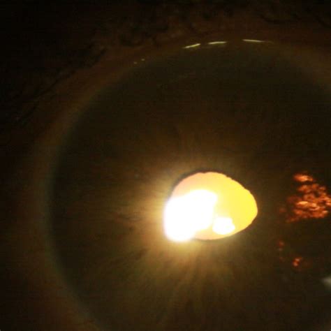 Transillumination Defects Of The Left Eye At 2 Weeks Download Scientific Diagram