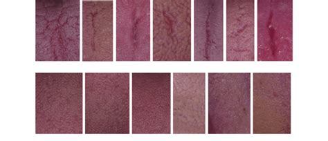 All Kinds Of Region Selected From Cracked Tongue And Normal Tongue Download Scientific Diagram