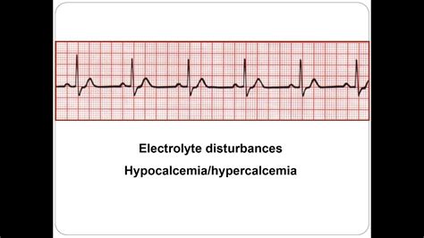 Ecg Ion Abnormalities Hypo Hypercalcemia 2018 Youtube