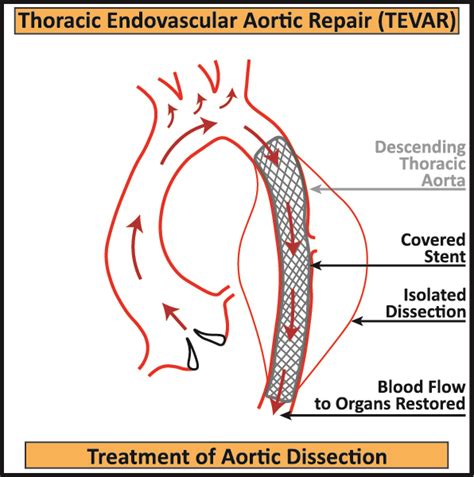 Aortic Dissection Surgery