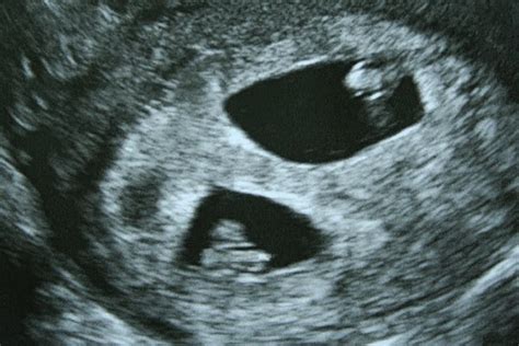 How To Apply ICD 10 CM Codes To Fetus 1 Fetus 2 Obstetrics