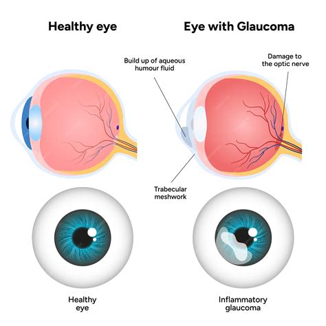 Premium Vector Healthy Eye And Eye With Glaucoma Ophthalmology Eye