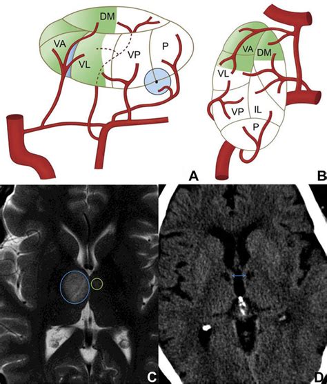 Schematic Diagram Of Lateral A And Dorsal B Views Of Tuberothalamic Download Scientific