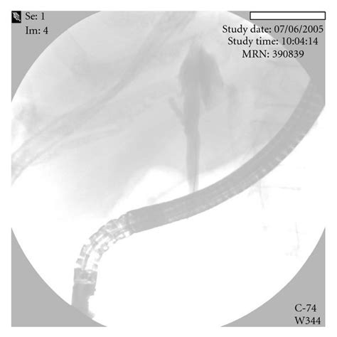 Ercp Showing A Stop At The Level Of The Biliary Confluence And A Download Scientific Diagram