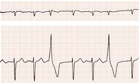 Ectopic Beats Thoracic Key