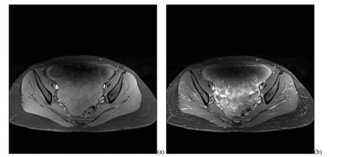 A Case Of Primary Ovarian Primitive Neuroectodermal Tumor Pmc