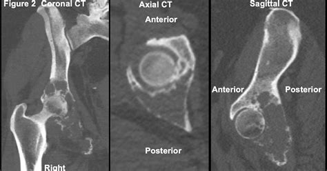Minimally Invasive Procedure Enhances Care For Periacetabular
