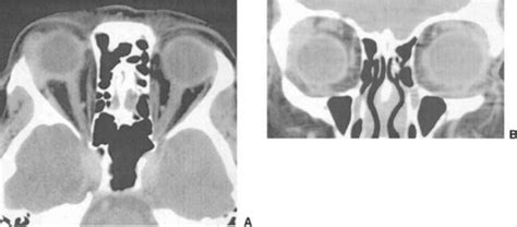 Computed Tomography Of The Orbit Ento Key