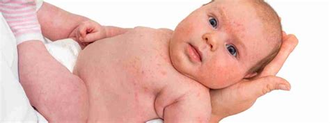 Вугри на шкірі новонароджених причини та лікування дитячого акне