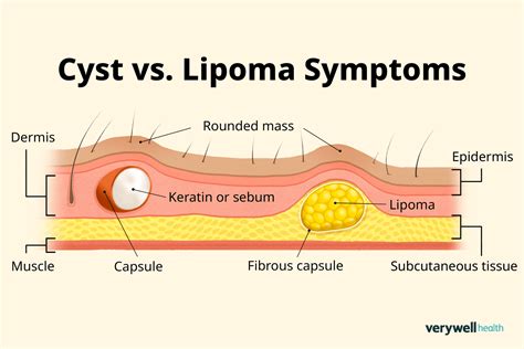 Cyst Vs Lipoma Symptoms Causes Treatment