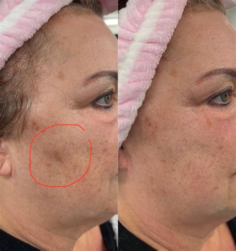 Cheek Filler A Comprehensive Guide