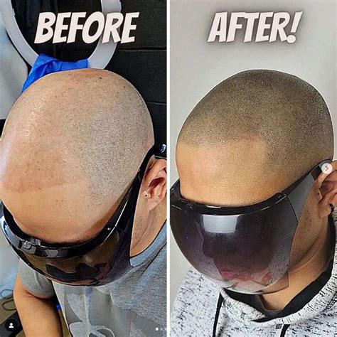 Scalp Micropigmentation Results Gallery Enhanced Scalp