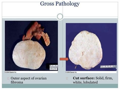 Sex Cord Stromal Tumors Pathology Pptx Reproductive Health Diseases And Conditions