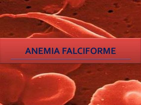 Sintomas Da Anemia Falciforme E Tratamentos DicasFree Com