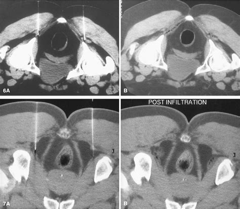 Pudendal Nerve Block Procedure