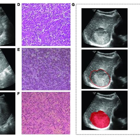 Ultrasound And Pathological Images Tumor Segmentation And Feature Download Scientific
