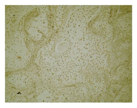 A B And C Epithelial Lining Of Inflammatory Fibrous